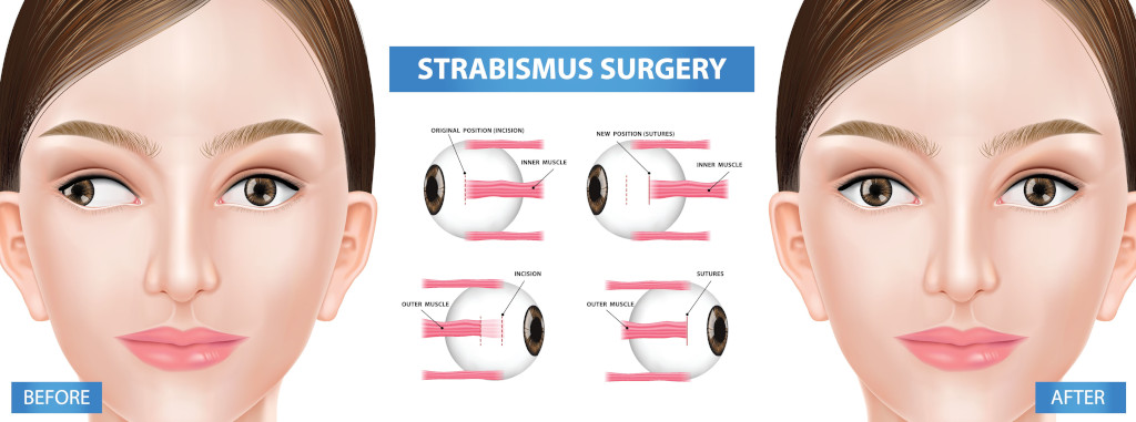 Strabismus Surgerysmall Red Rock Ophthalmology